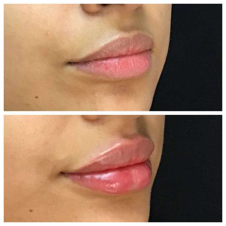 Restylane | Radiesse | Belotero | Juvederm | Dermal Fillers Las Vegas NV